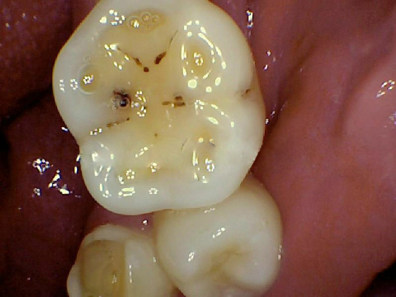 New Dentist Dental 5.0MP USB IntraOral Oral Camera HK790 LED+Software ...