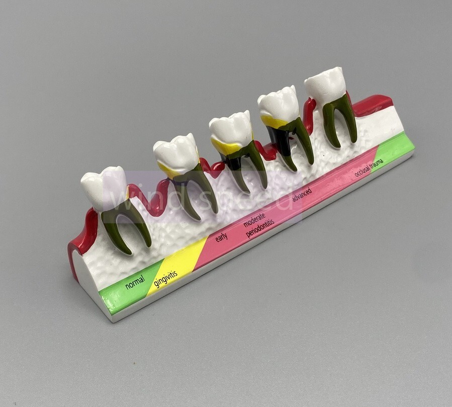 Dental Study Teaching Model Periodontal Disease Assort Teeth Dentoform ...