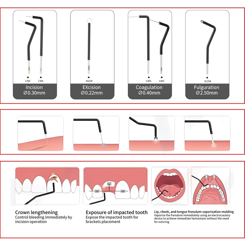 Dental Electrode Tips Electrosurgery tips 7PCS Set Fit Oral ...