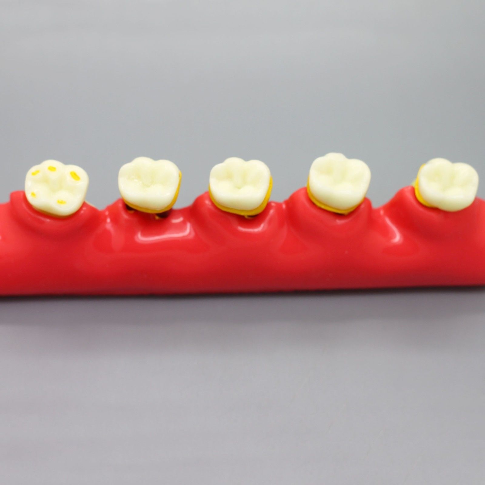 Dental 5-Stage Periodontal Teeth Disease Dentoform Typodont Assort ...