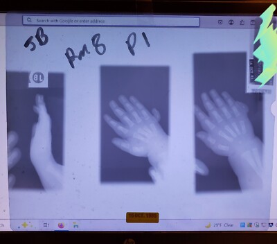 Vintage Real X-ray Film POLYDACTYLY Birth Defect EXTRA FINGER Bones ...