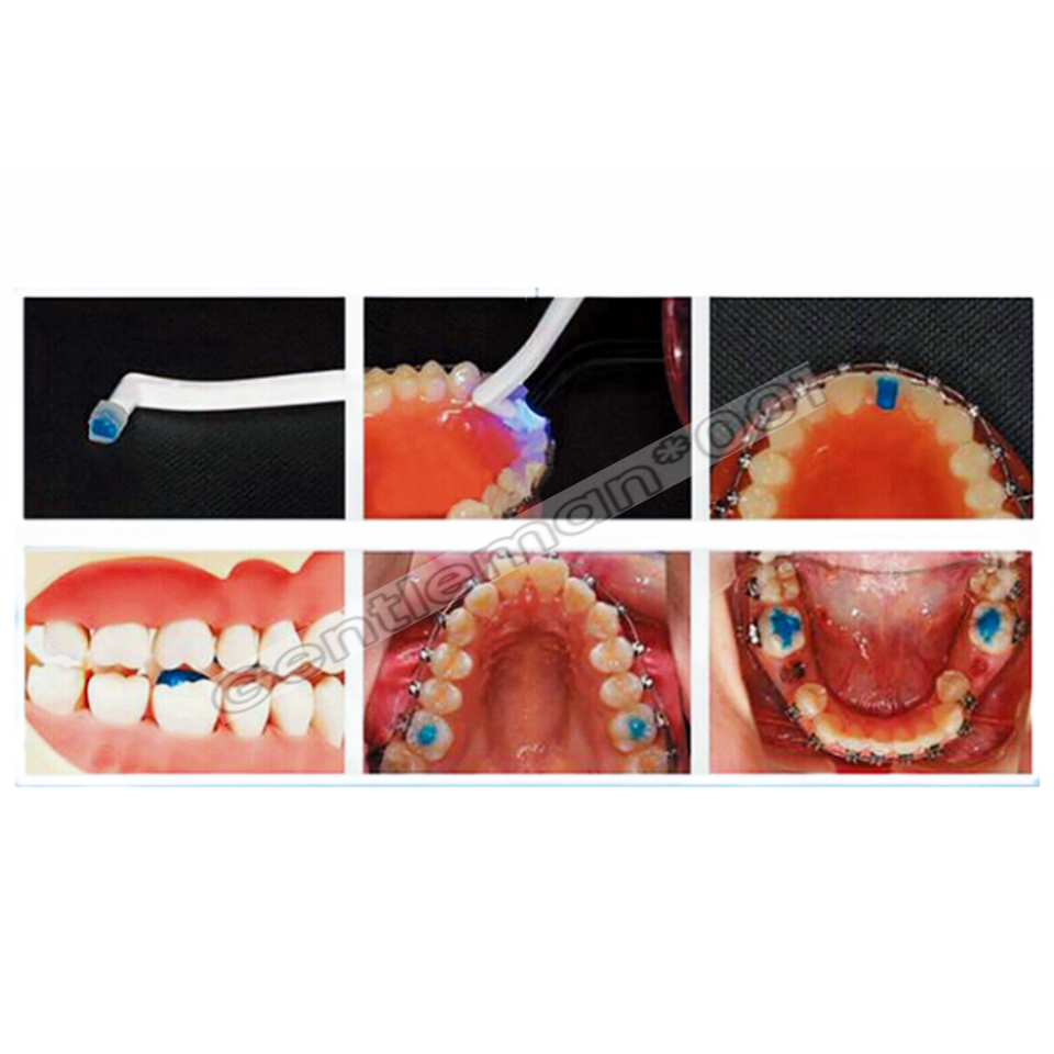 Dental Orthodontic Brackets Bonding Adhesive Light Cure Band Cement ...