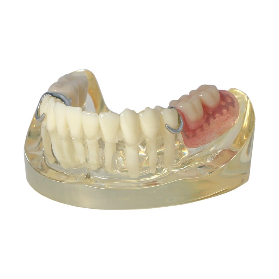 Dental M6022 Implant Restoration Typodont Teeth Model with Partial ...