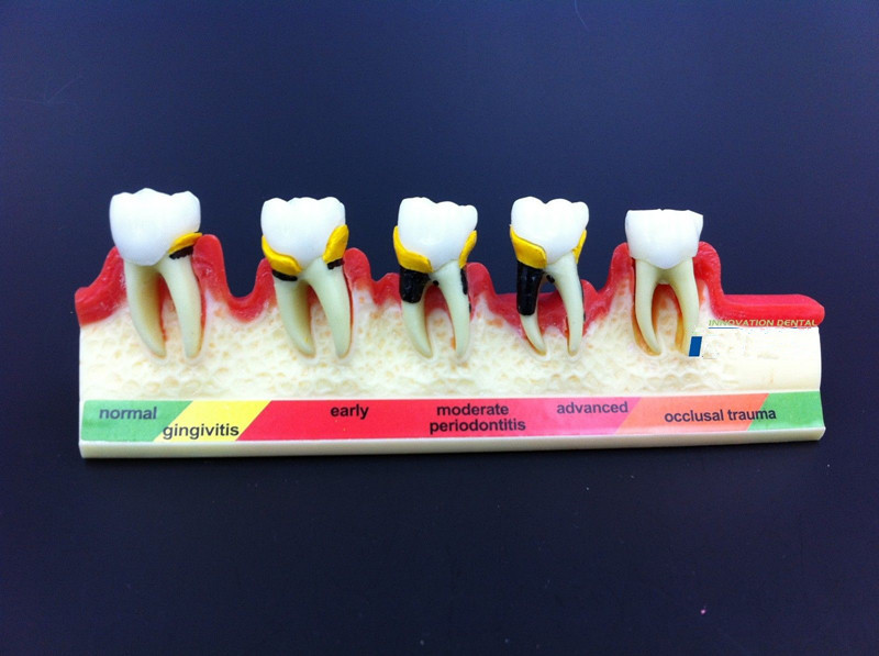 Dental Teeth Model Periodontal Disease Assort Tooth Classification ...