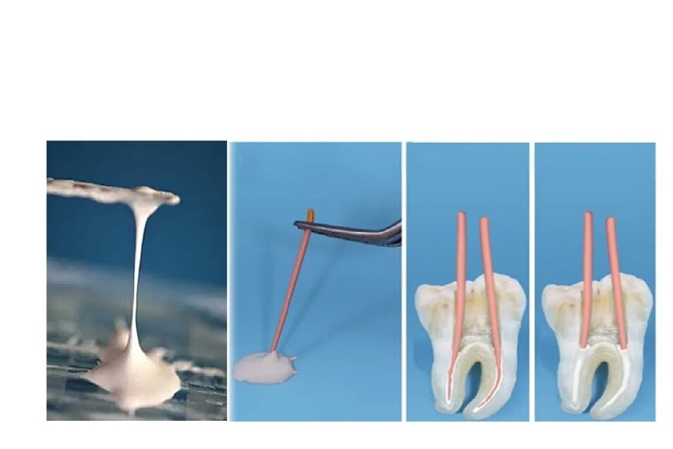 PREVEST DENPRO CALAPEX ROOT CANAL SEALER (Manual-Mix) | eBay