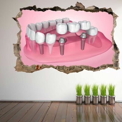 Dental Tooth Implant 3D Wall Sticker Mural Decal Surgery Office Decor ...