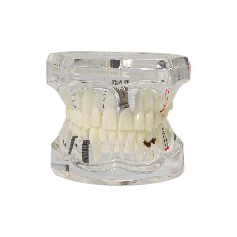 Dental Implant Teeth Model Teach Study Demo Restoration Pathology ...