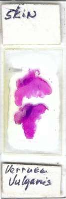 Human Wart Verruca Vulgaris Pathology Microscope Slide | eBay