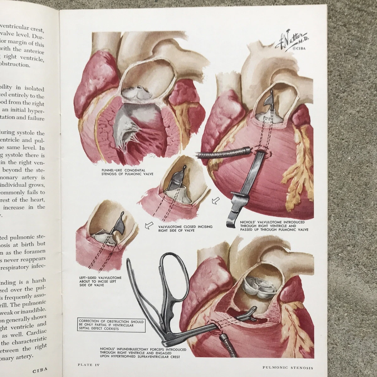 Coronary Arteries Netter