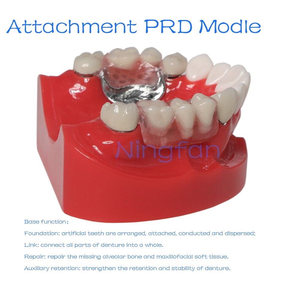 Dental RPD Removable Partial dentures Model Typodont lmplant Model | eBay