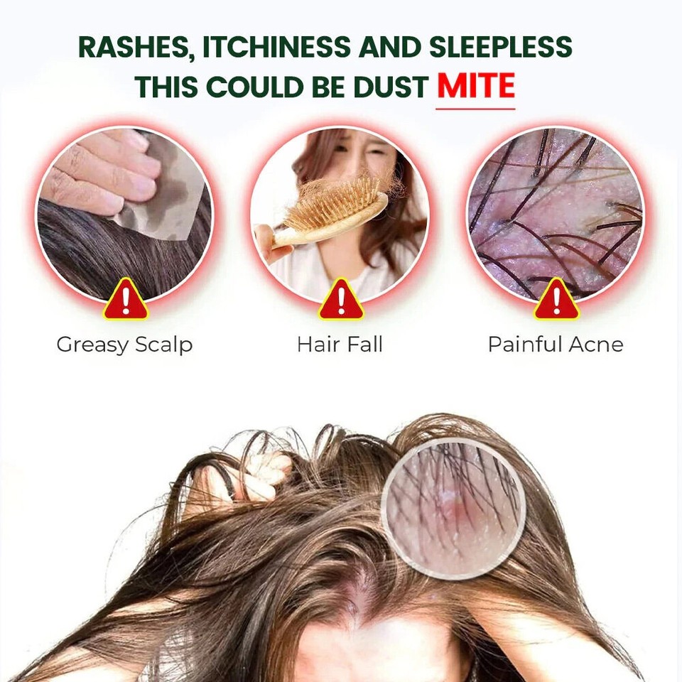 New 30g Mite Removal Anti-Itching Cream Scabies Kill Head Lice Skin ...