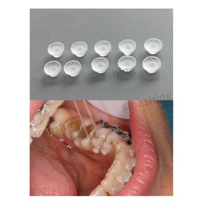 Dental Lingual Button Ceramic Clear Invisable Retainer Aligner Bondable ...