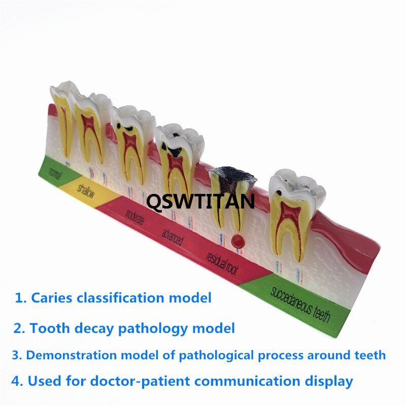 Dental Caries Process PPT What Are The Stages Of Tooth Decay