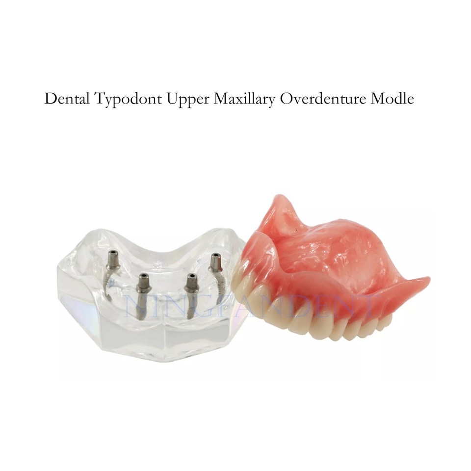 Dental Implant Modle,Lower Upper Jaw,RPD Dentures,Overdenture ...