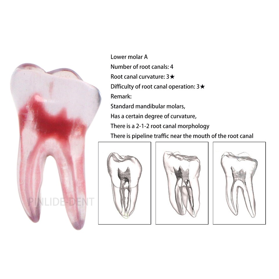 Dental Resin Root Canal Teeth Model Endo Practice Block RCT Pulp Cavity ...