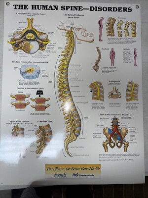 Human Spine Disorders Anatomical Chart 26” X 20” | eBay