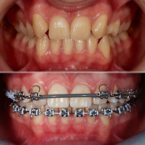 20x Dental Ortho Archwire Elastic Tube Protective Sleeve Elastomeric ...