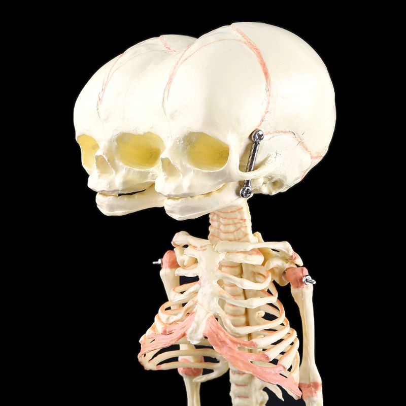 Human Baby Deformed for Head Skull Research Model Skeleton Anatomical ...