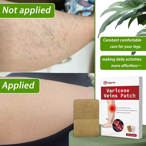 tigerty Varicose Veins Patch Vasculitis Phlebitis Spider Leg Treat ...