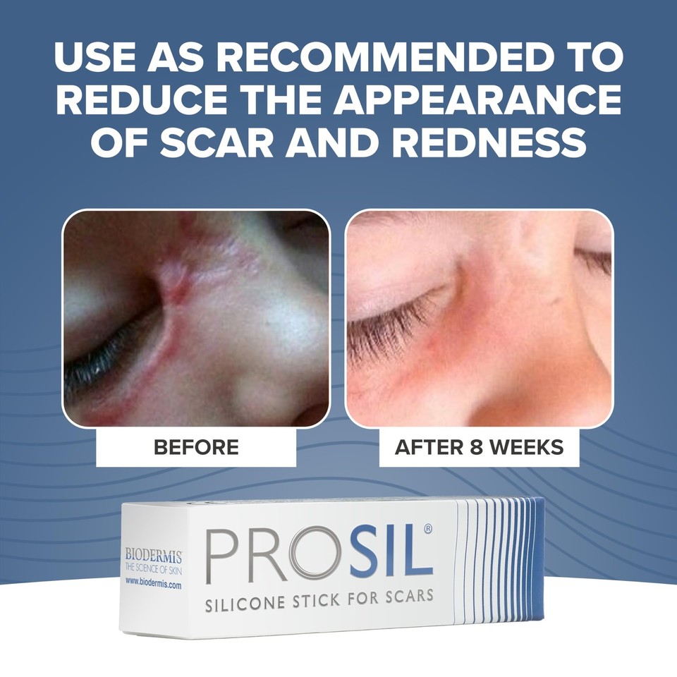 Prosil Silicone Scar Stick 4.25G – Effective Scar Treatment With Premi ...