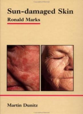 Sun-Damaged Skin: Pocketbook By Ronald Marks | eBay