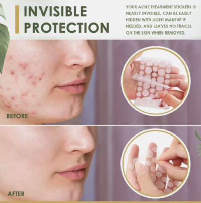 36PCS Acne Patch /MOLE/ Skin Tag Remover Plaster Hydrocolloid Pimple ...
