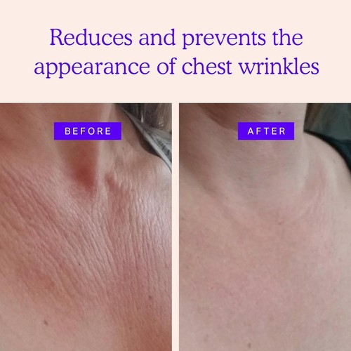 Chest Wrinkle Pads-Silicone Patches for Wrinkles -100% results and ...