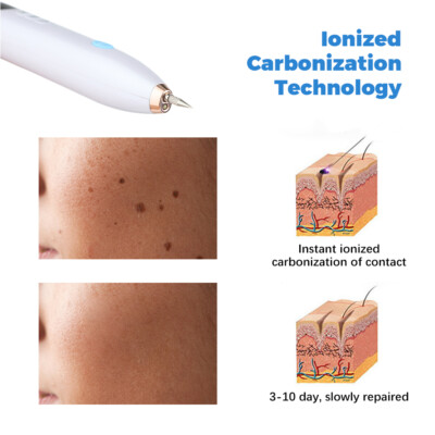 Laser Skin Tag Remover Face Mole Remove Plasma Pen Freckle Removal ...