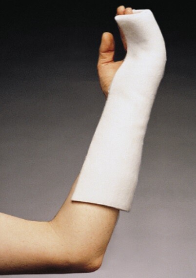 Boxer Fracture Ulnar Gutter Splint My Xxx Hot Girl