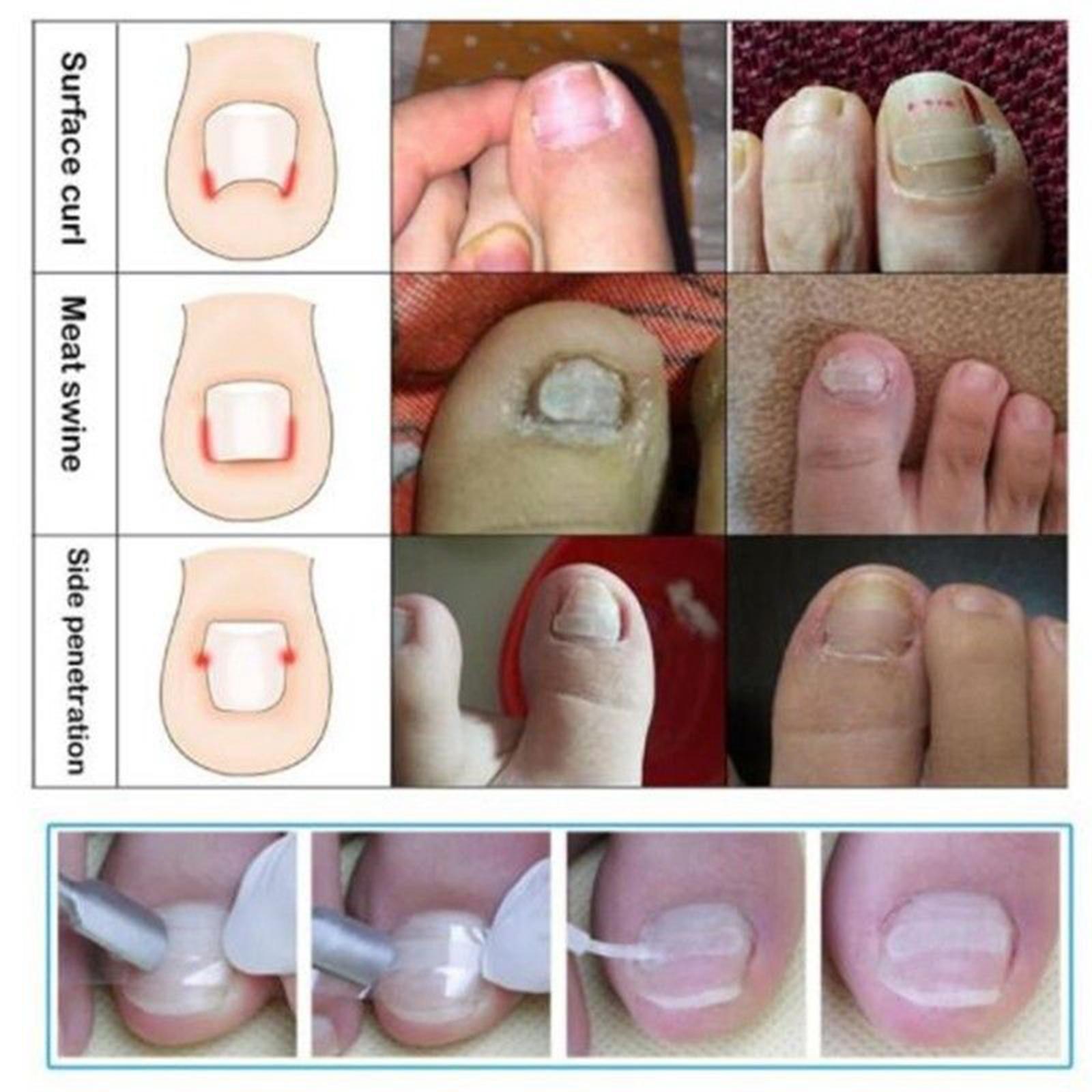 Corrective Patch for Ingrown Toenails. Toenail Brace Treatment | eBay