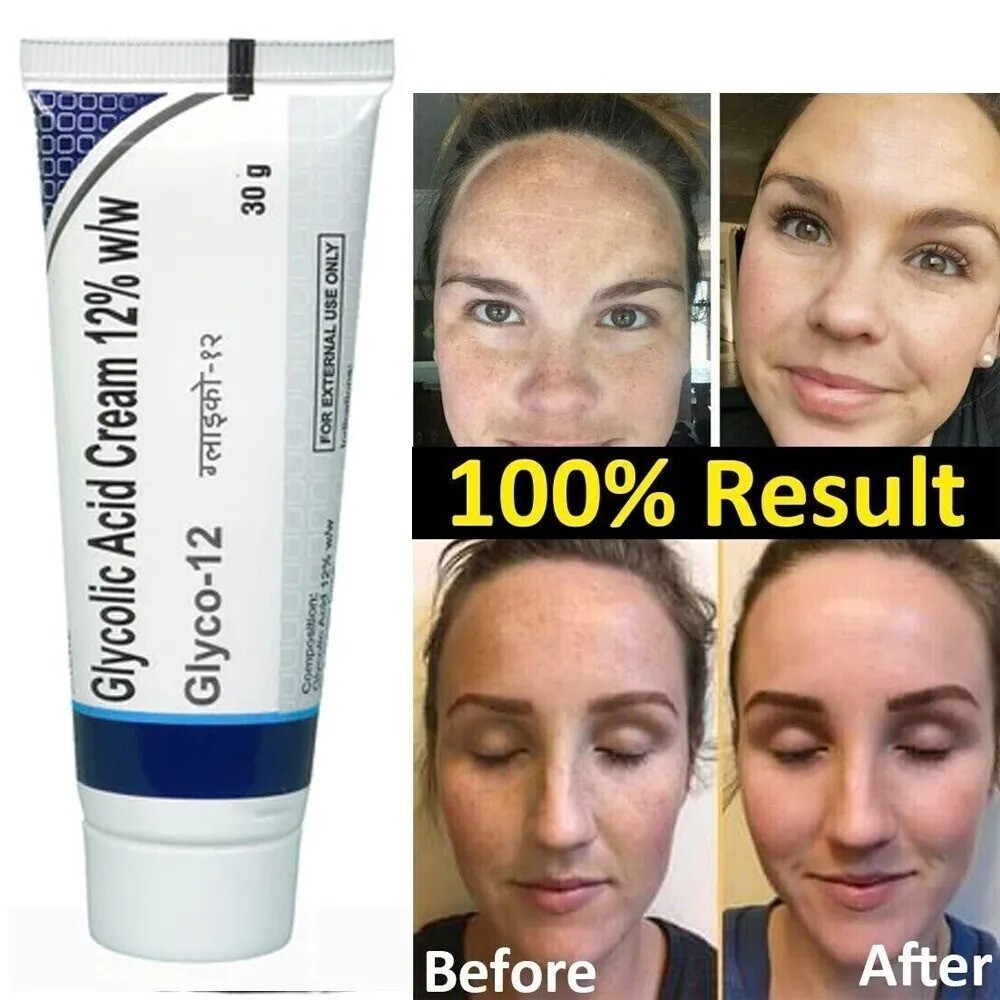 Glyco-12 Glycolic Acid Cream | For Dry Skin, Acne and Hyperpigmentation ...