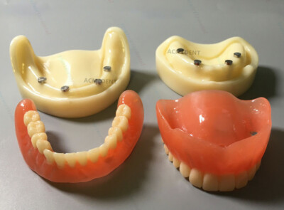 Dental Full Denture Model Overdenture Magnetic Attachment Mandibular ...