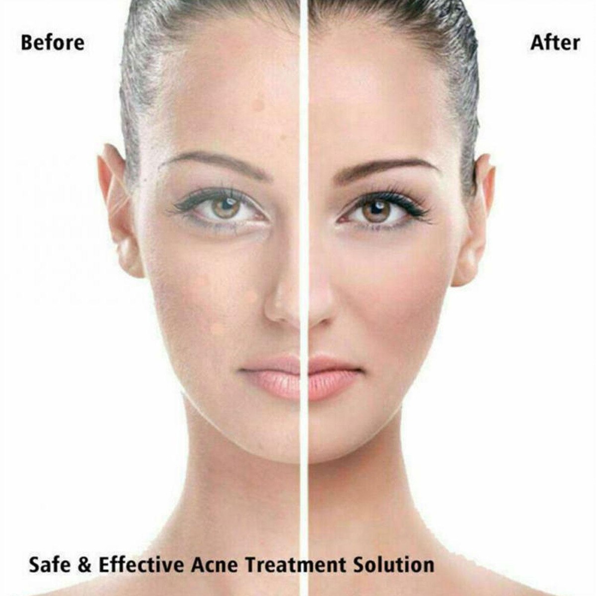 Concealer Before And After Pimple