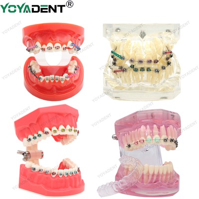 Dental Orthodontic Teeth Model Demonstration with Braces For Patient ...
