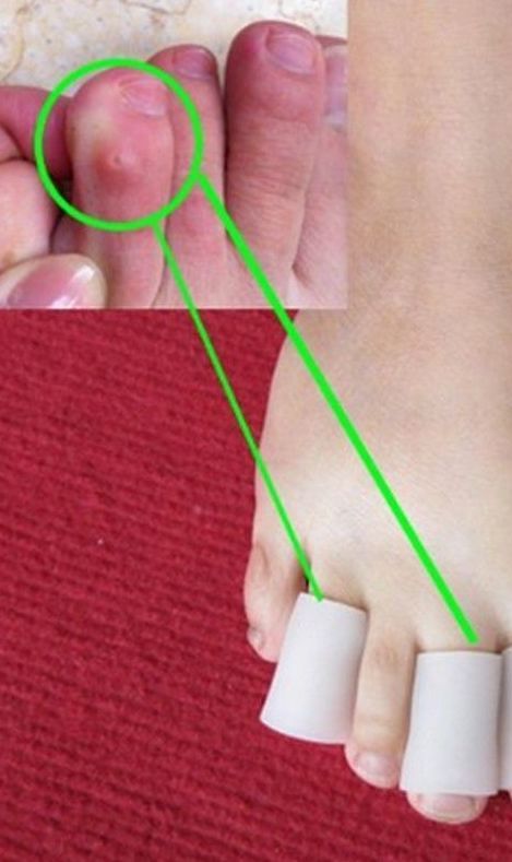 2 Pair Toe Sleeves Toe Protector Finger Protectors Protect Relieve Pain ...