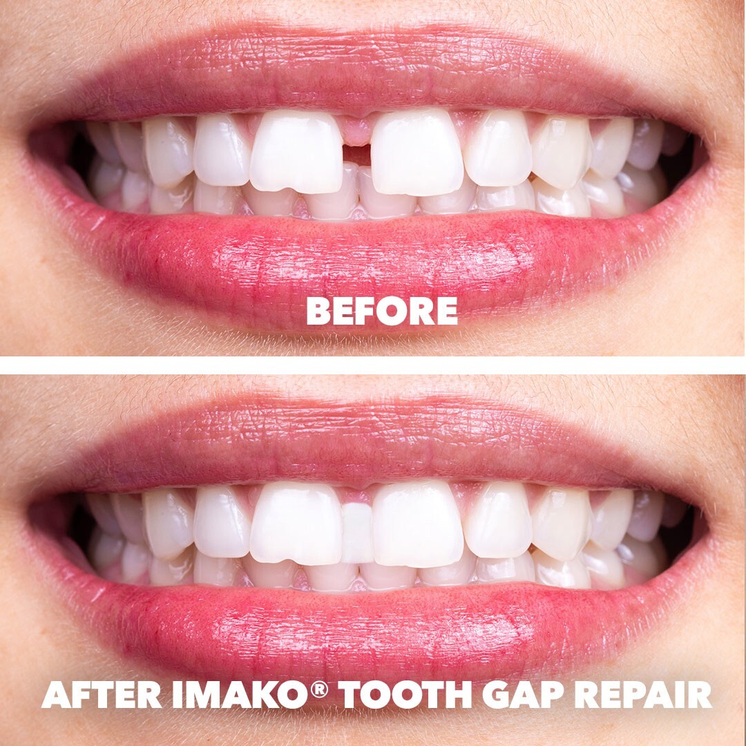 Imako® Tooth Tinted Plastic - Temporary Tooth - Fix Chipped Teeth, Gaps ...