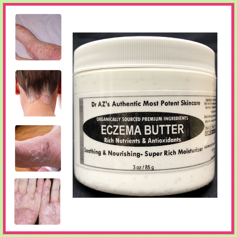 Intense Treatment Cream for Eczema Psoriasis Rosacea Dermatitis ...