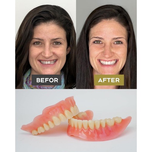 2025 NEW DIY DENTURE KIT Custom Homemade Dentures For Begginers FULL ...