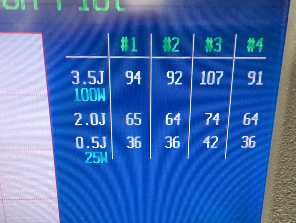 Lumenis VersaPulse PowerSuite 100 Watt Holmium Laser BPH HoLEP Videos ...