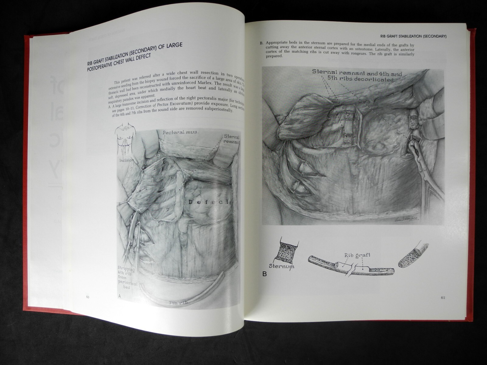 Atlas of General Thoracic Surgery by Felician M. Steichen and Mark M ...