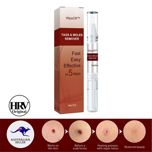 Wipe Off Skin Tags Moles Wart Remover Liquid Pen Fast Effect Genuine ...