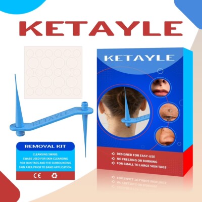 Rubber Bands Skin Tag Remover Skin Tag Removal Kit Mole Wart Tool Face ...