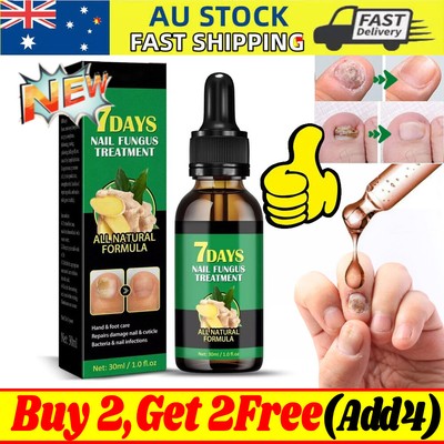 Ginger Nail Fungus Treatment Nail care| Nail Growth Oil for Cuticle ...