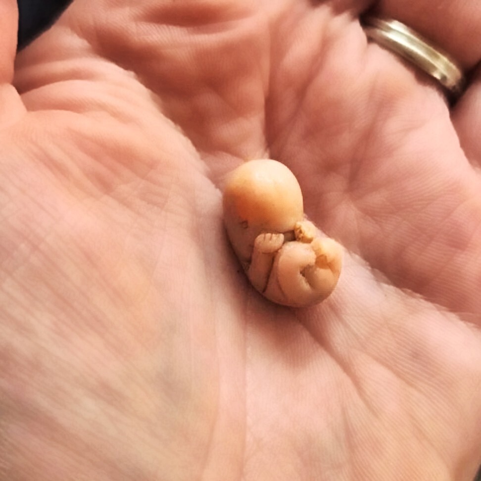Miscarriage At 8 Weeks Fetus