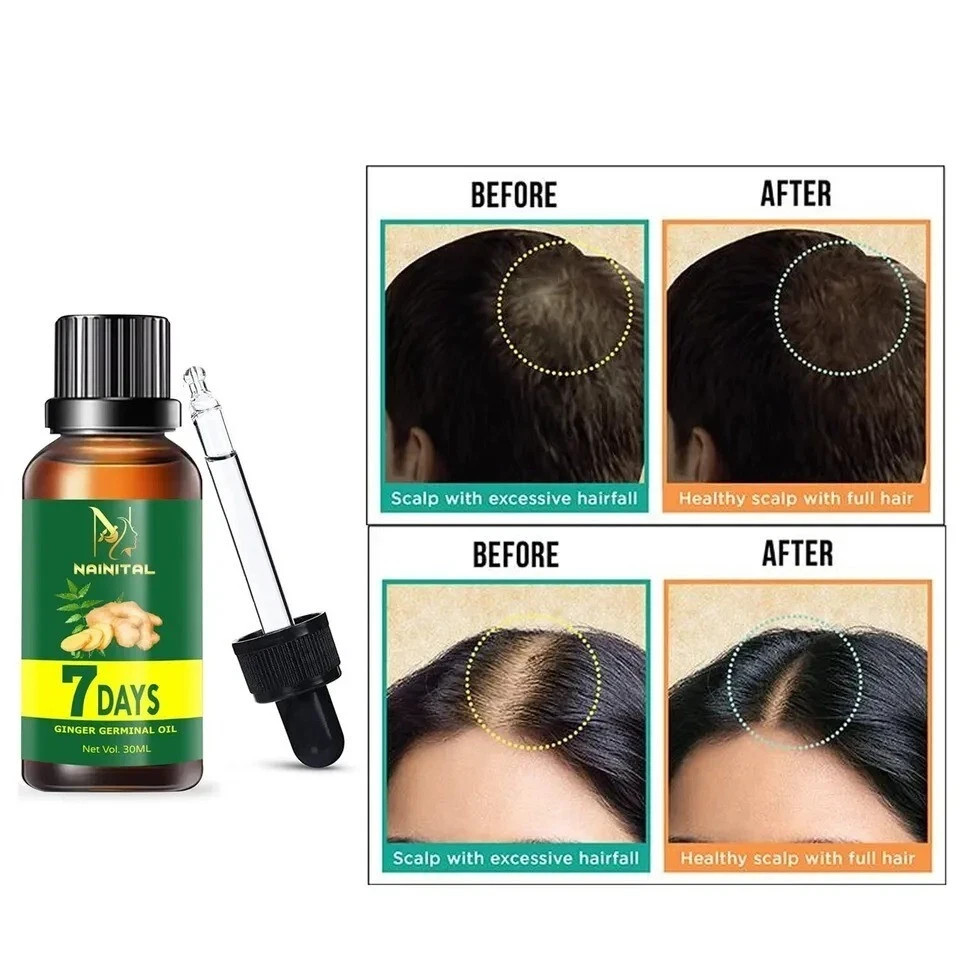 Noor Hair Growth Serum 30ml – Bald Spots, Receding Hairline ...