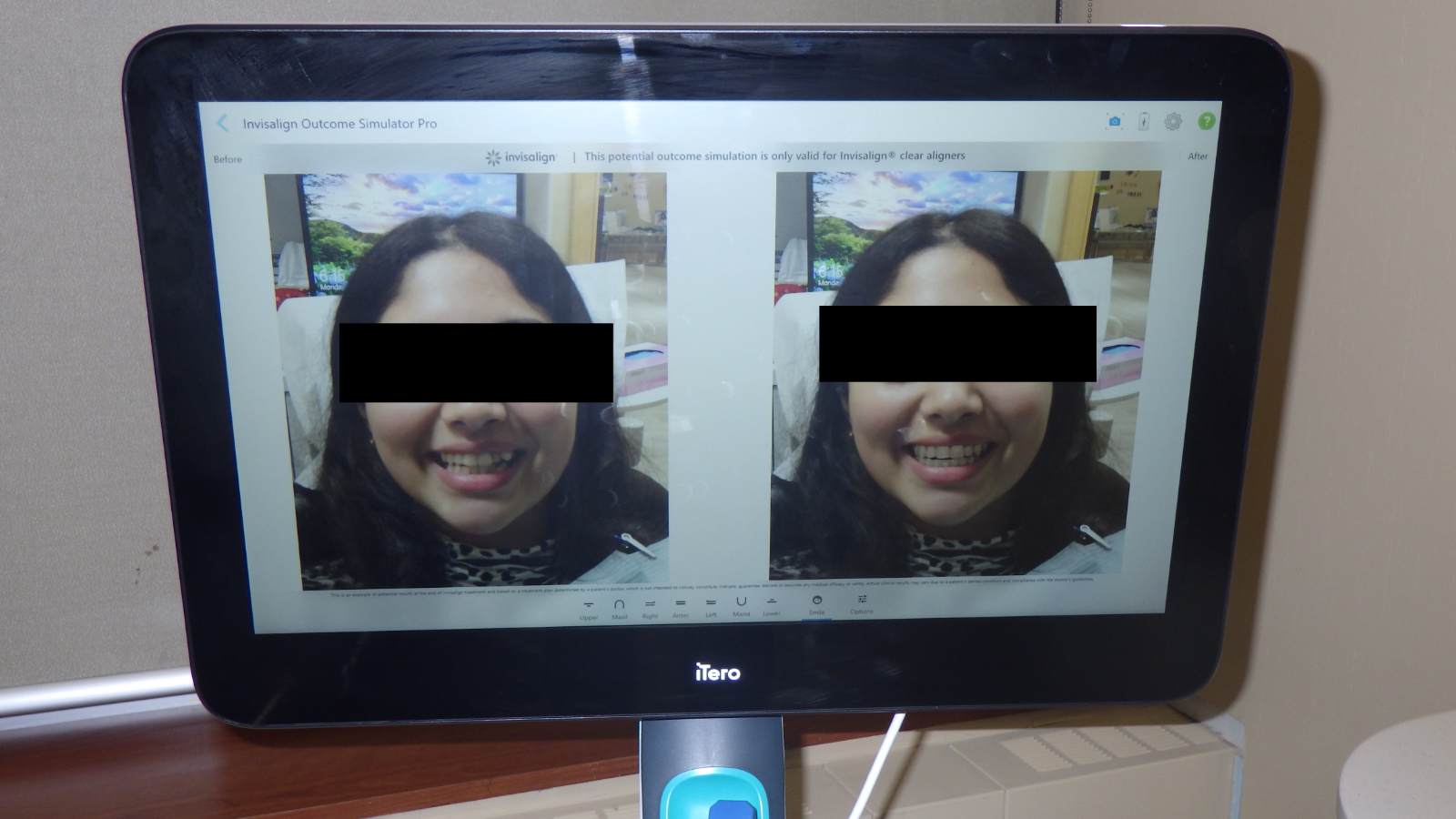 iTero Element 5D Plus Dental Scanner | eBay