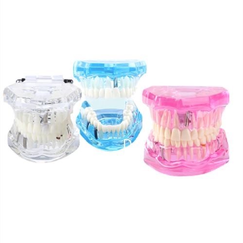 Dental Restoration Typodont Study Teeth Teaching Model Demonstration ...