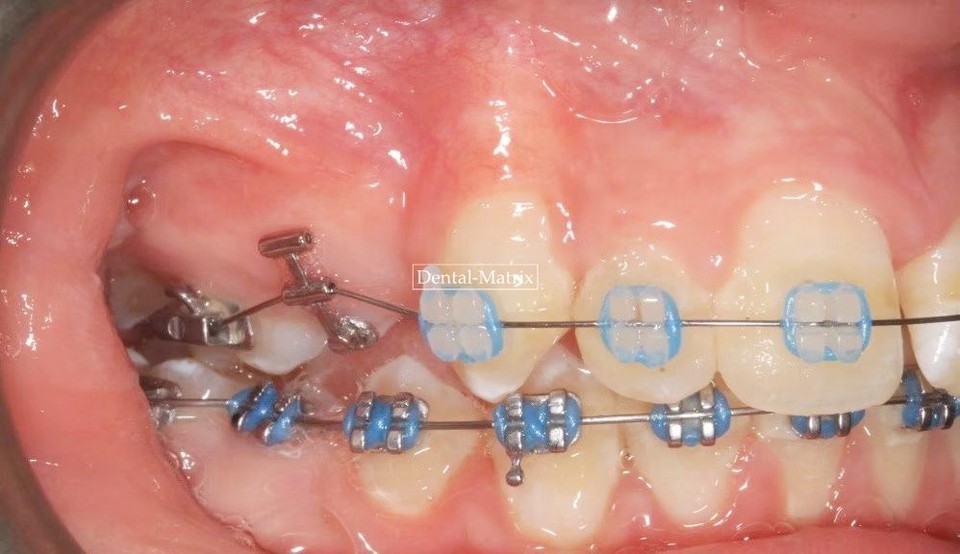 Dental Orthodontic Appliance Molar Pusher Distalizer Lingual Brackets ...