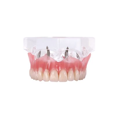 Dental Upper Implants Model Overdenture with 4 Superior Teeth Demo ...