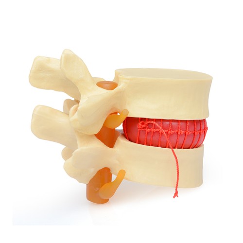 1:1 Human Anatomy Skeleton Spine Lumbar Disc Herniation Teaching Model ...